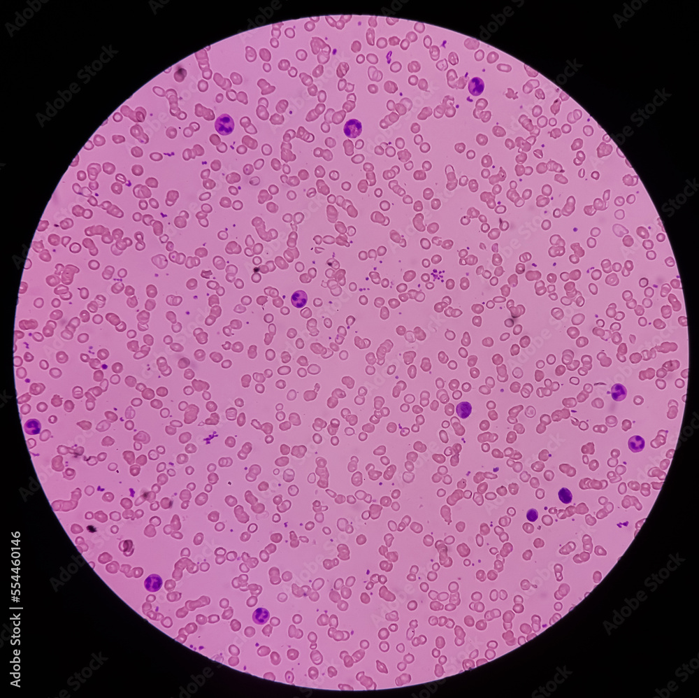 Microscopic view of blood smear, Hereditary hemolytic anemia ...