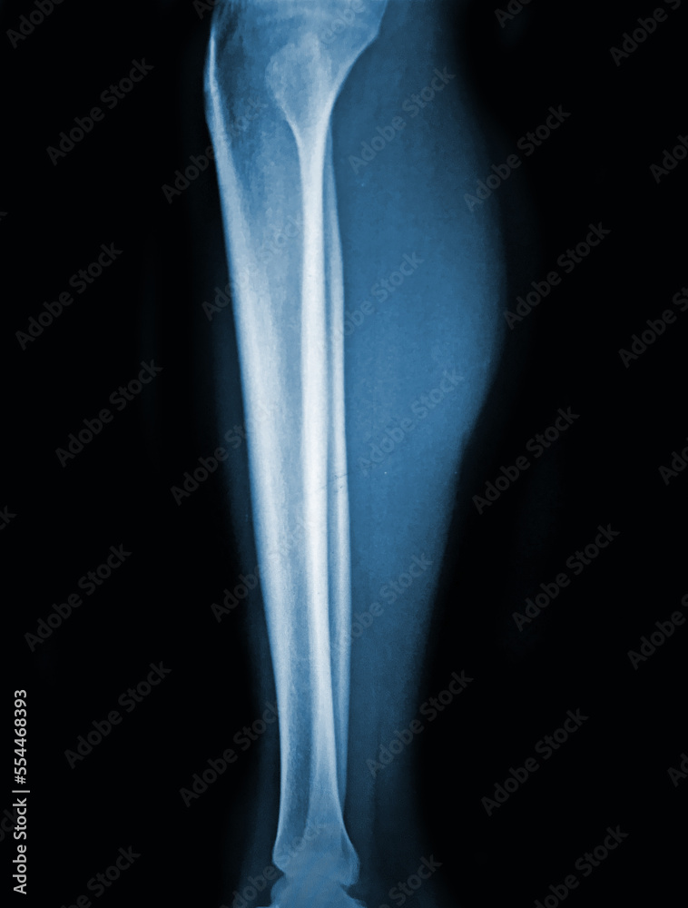 X-ray normal human tibia Lateral view Stock Photo | Adobe Stock