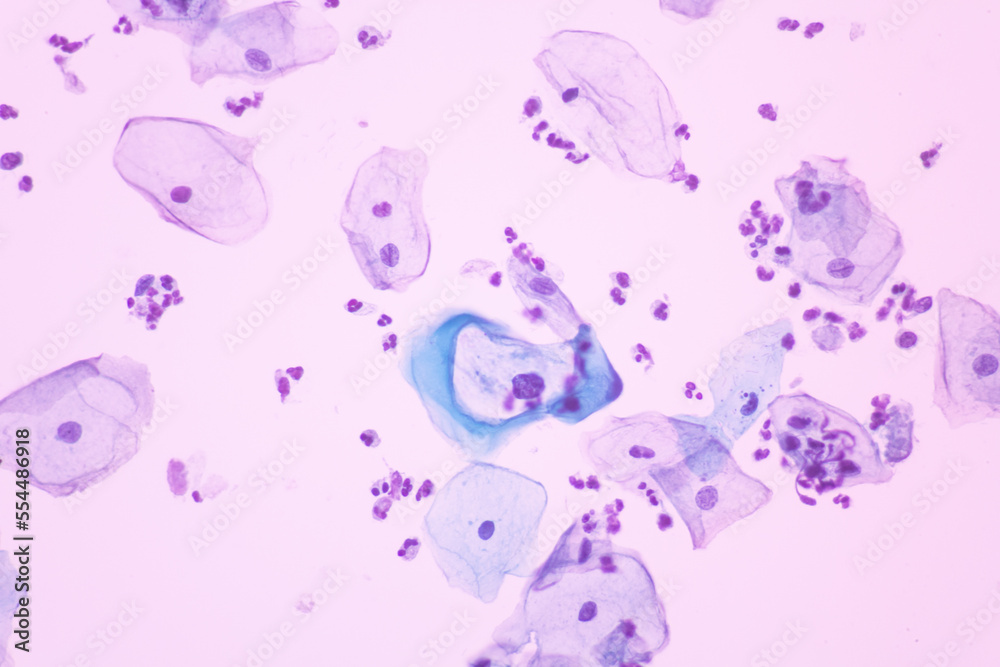 Abnormal squamous epithelial cells view in microscopy.HPV criteria for ...