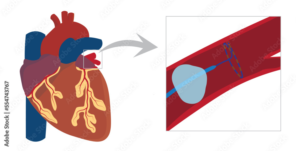 Cardiac cryoablation illustration. Inside pulmonar vein and catheter ...