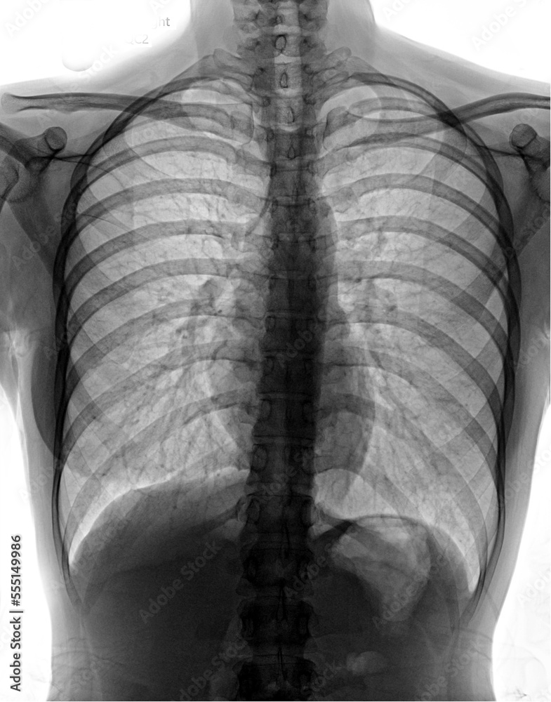 Bronchiectasis . X-ray chest show multiple lung bleb and cyst due to ...