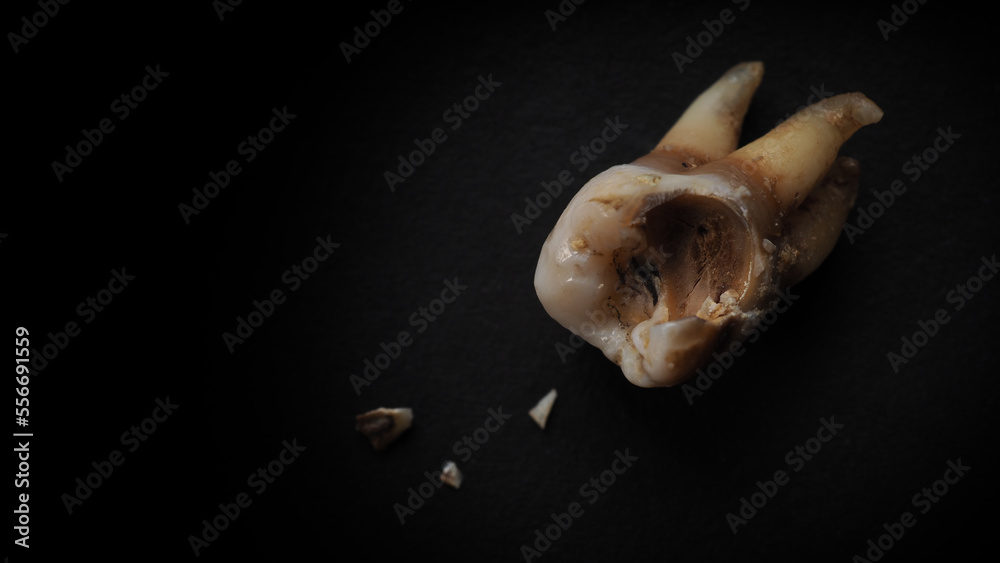 Tooth decay on black background. Macro shot of a decayed teeth till ...