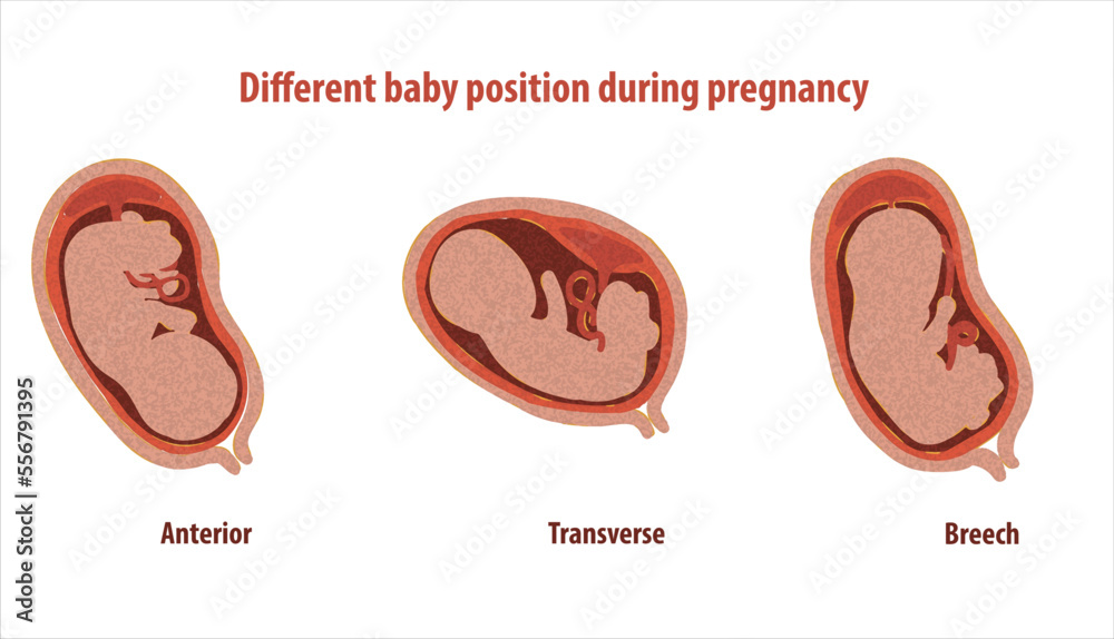 Different baby position during pregnancy. Anterior, transverse, breech ...