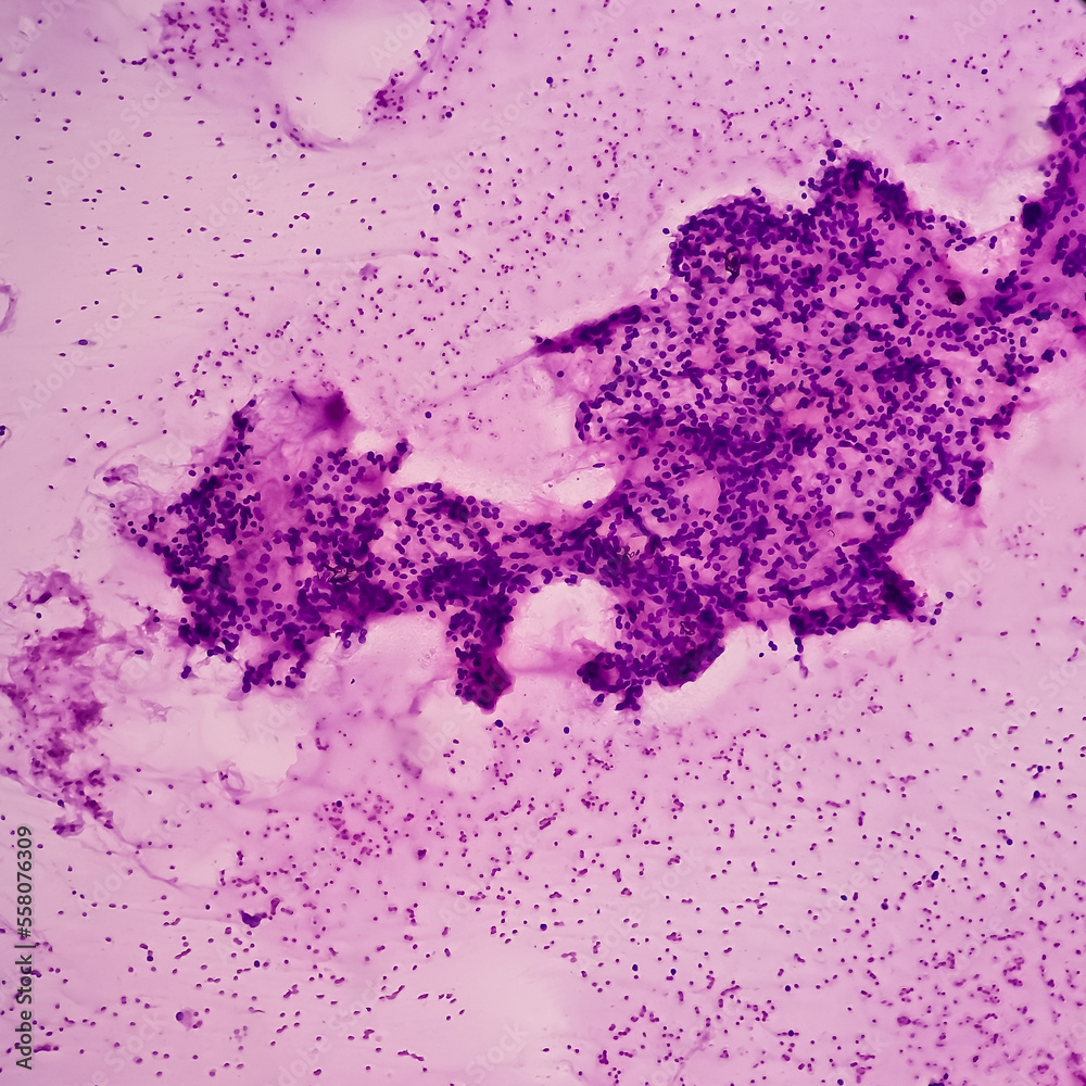 Thyroid nodule (FNA cytology): Cellular follicular lesion, microscopic ...