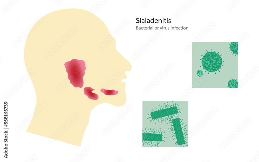 Sialadenitis - salivary gland inflamation caused by a virus or ...
