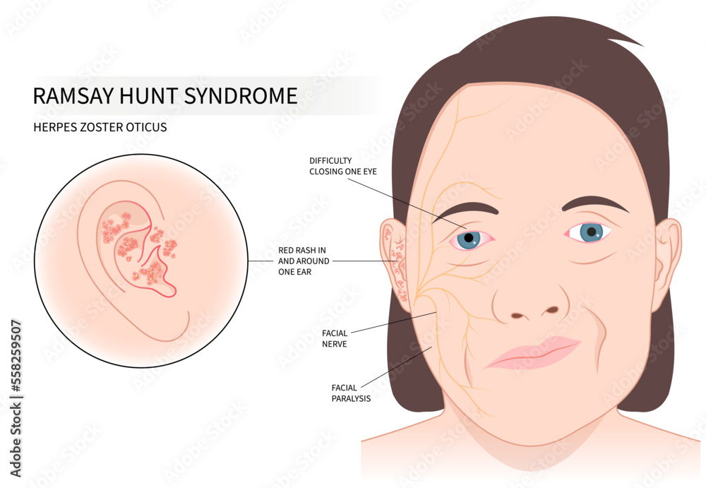 Face ptosis of bell's cranial central motor neuron Infectious chicken ...