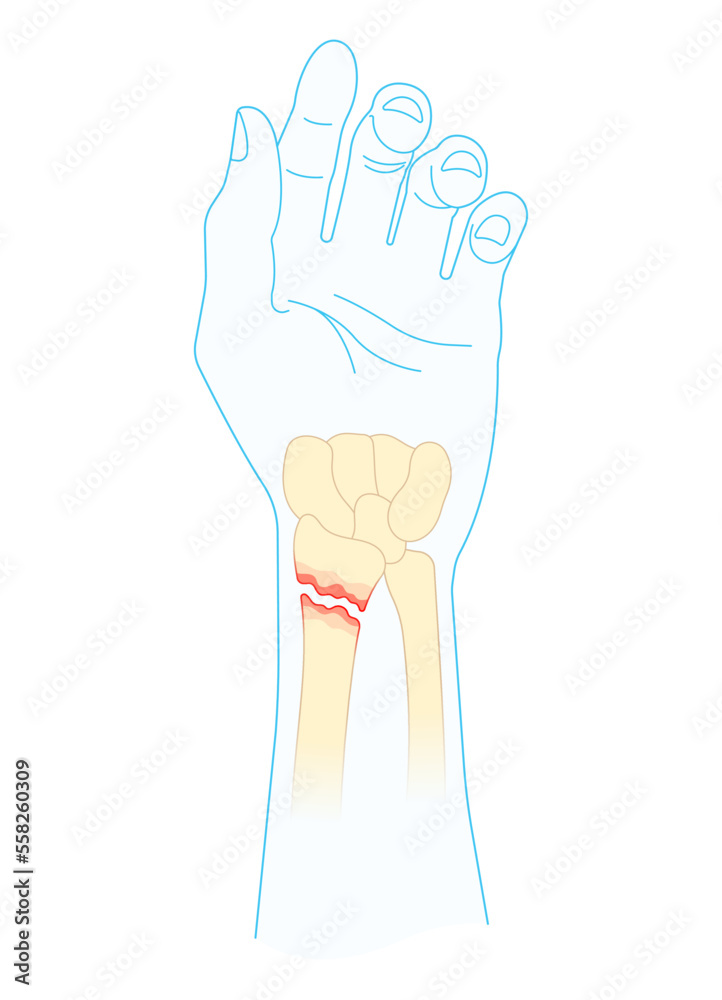 Hand break painful radial dislocated fall onto an outstretched closed ...