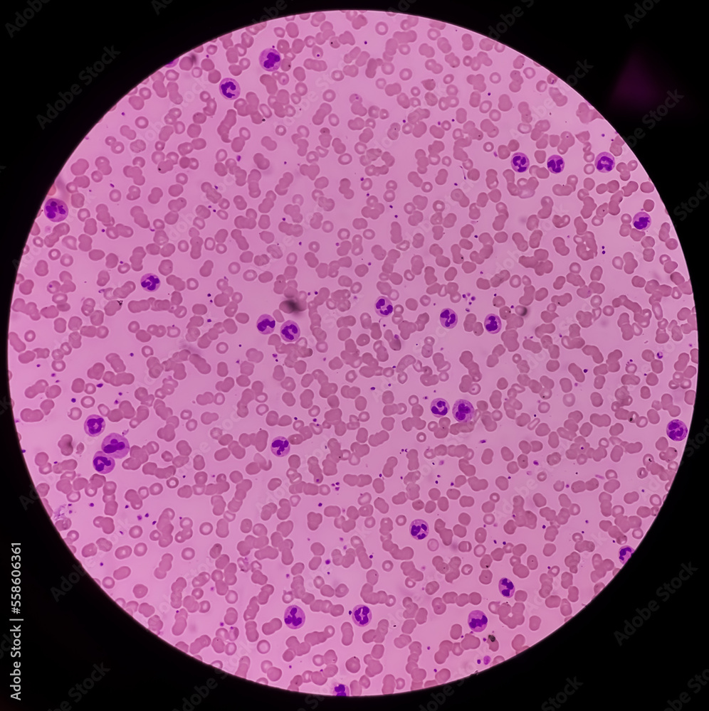 Microscopic finding, Neutrophilic leukocytosis with thrombocytosis ...