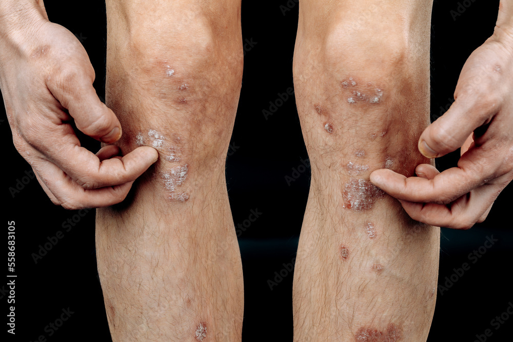 Eczema on the legs. Atopic dermatitis close-up. Allergic spots and red ...