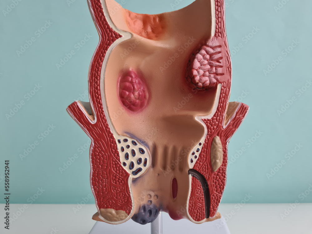 Anatomical model of rectum with hemorrhoids closeup Stock Photo | Adobe Stock