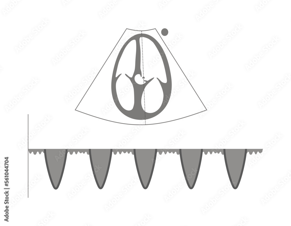 Infographic of Echocardiography of Left Ventricular Outflow Tract ...