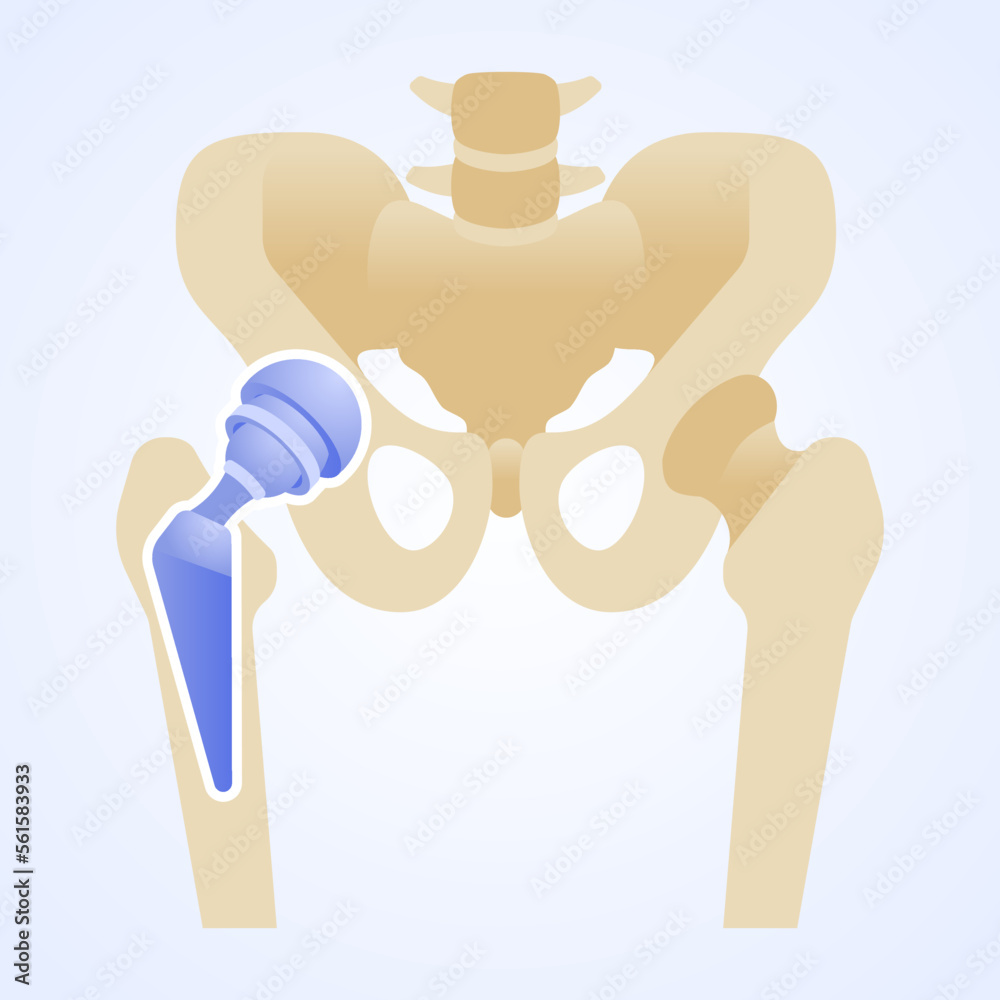 Titanium joint. Total hip replacement or arthroplasty. Structure of the ...