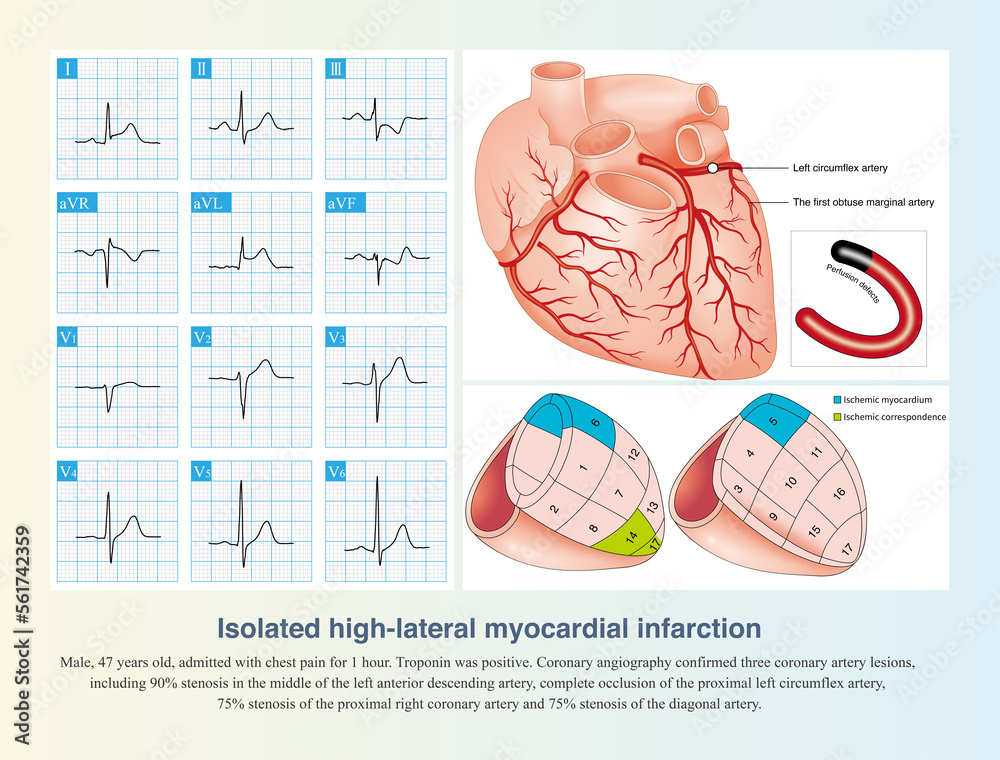 Ilustración de Stock Isolated occlusion of left circumflex artery can lead to isolated high ...