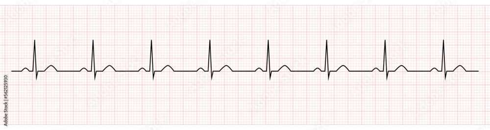 EKG showing normal sinus rhythm of patient Stock Vector | Adobe Stock