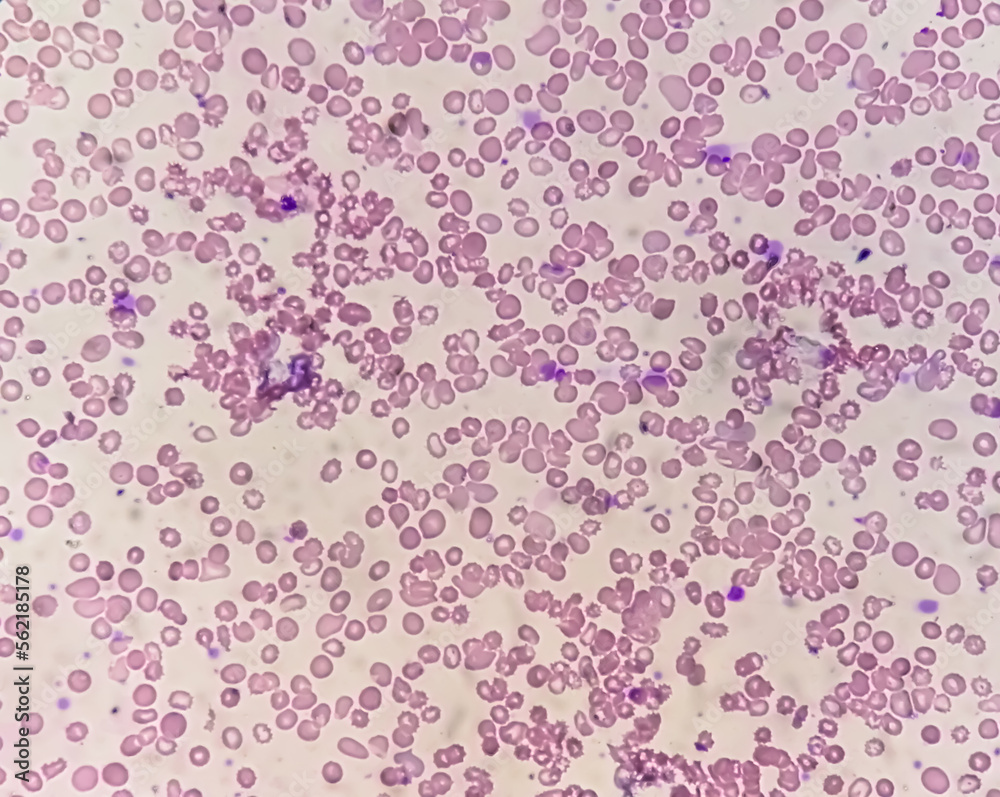 Microscopic view of hematological slide showing Pancytopenia. A ...