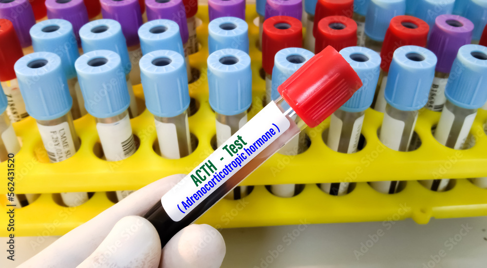 Blood sample for Adrenocorticotropic hormone (ACTH) test, diagnosis of ...