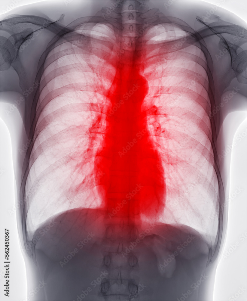 Chest x-ray image for screening diagnosis TB,tuberculosis and covid-19 ... Chest x-ray image for screening diagnosis TB,tuberculosis and covid-19 ...