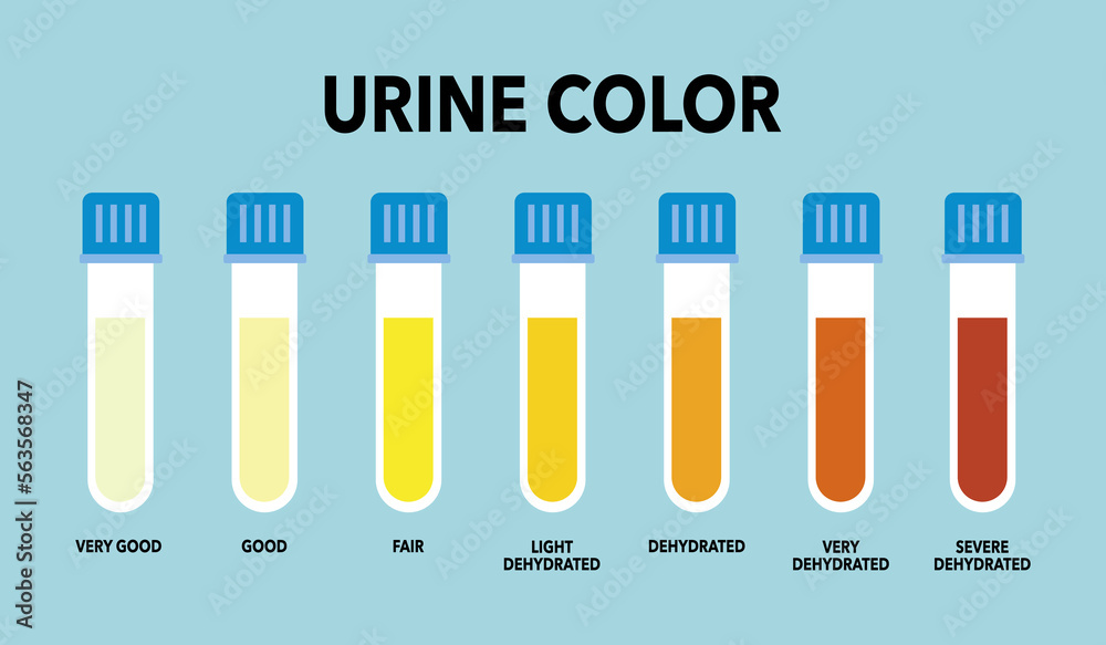 Urine color chart and meaning infographic in flat design. Stock Vector ...