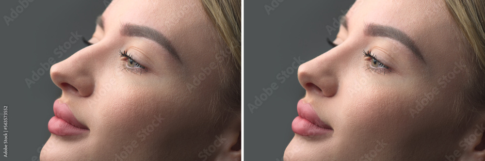Stock-Foto „Nose Before and after plastic surgery. Rhinoplasty. Crooked ...