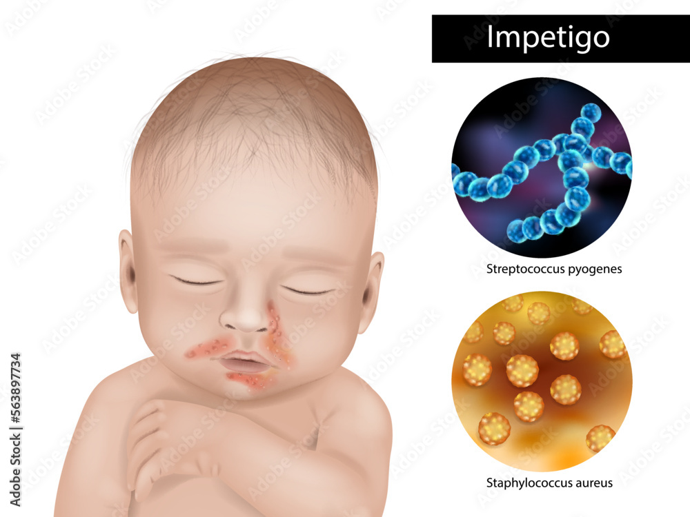 Impetigo is an infection caused by strains of staphylococcus or ...