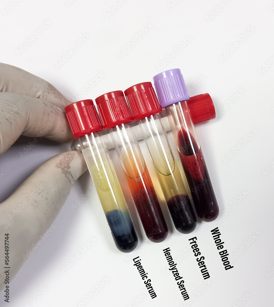 ภาพถ่าย Stock Lipemic blood sample, frees serum, whole blood, hemolyzed ...