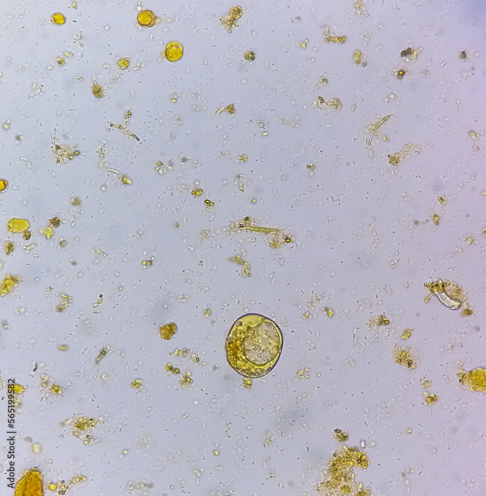 Microscopic examination of Stool showing Blastocystis hominis parasite ...