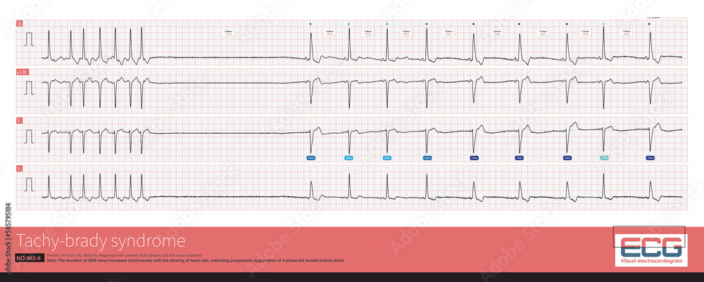 After the paroxysmal atrial fibrillation attack stopped, there was a ...