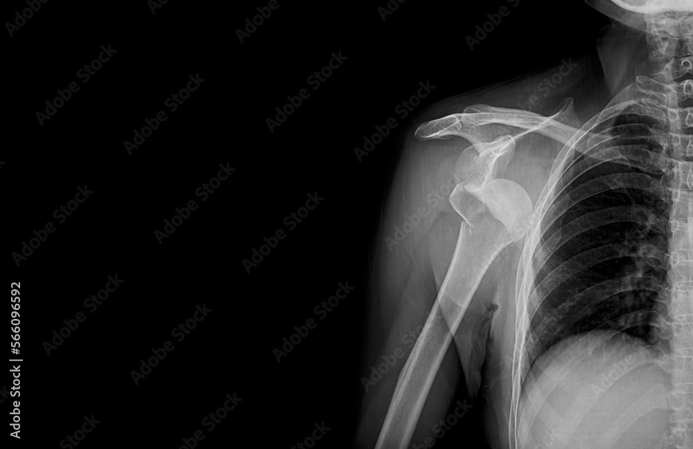 Photo of plain radiograph on dark background in hospital. The film use ...