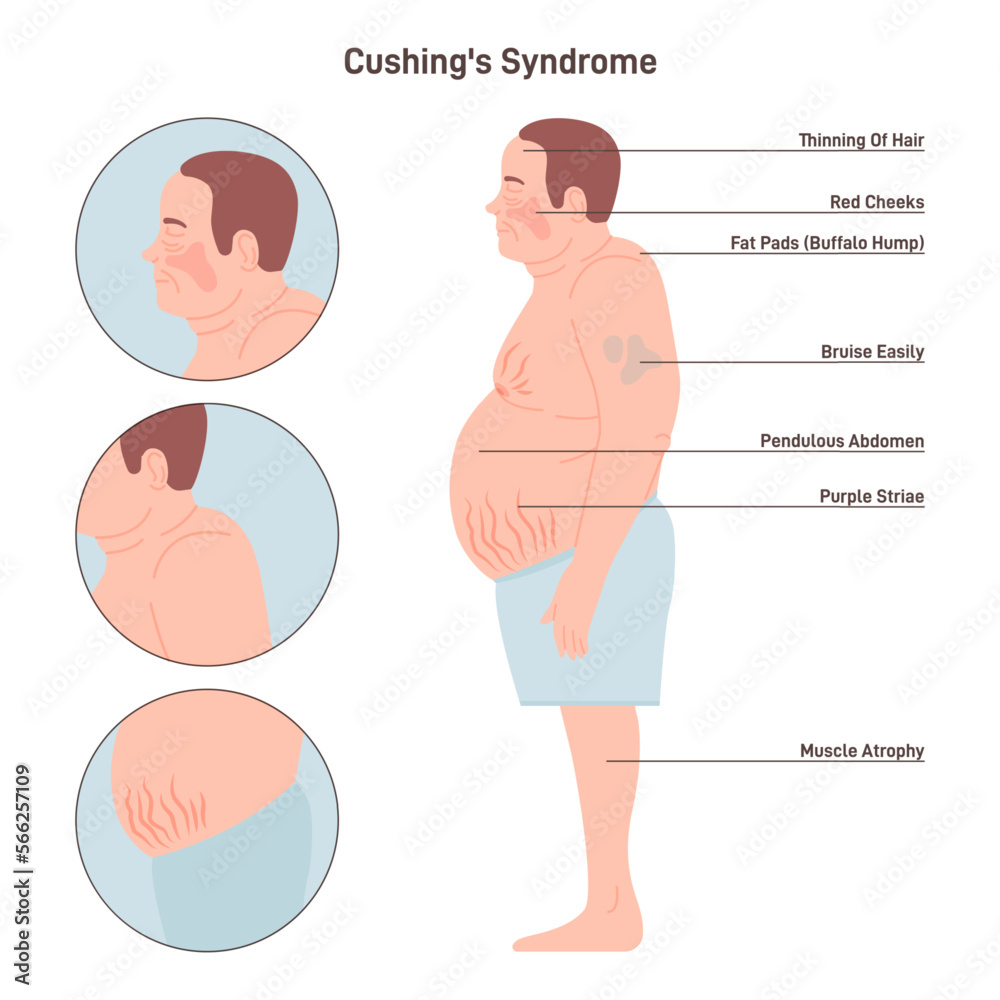 Vector de Stock Cushing's syndrome. Excess cortisol production. Male ...