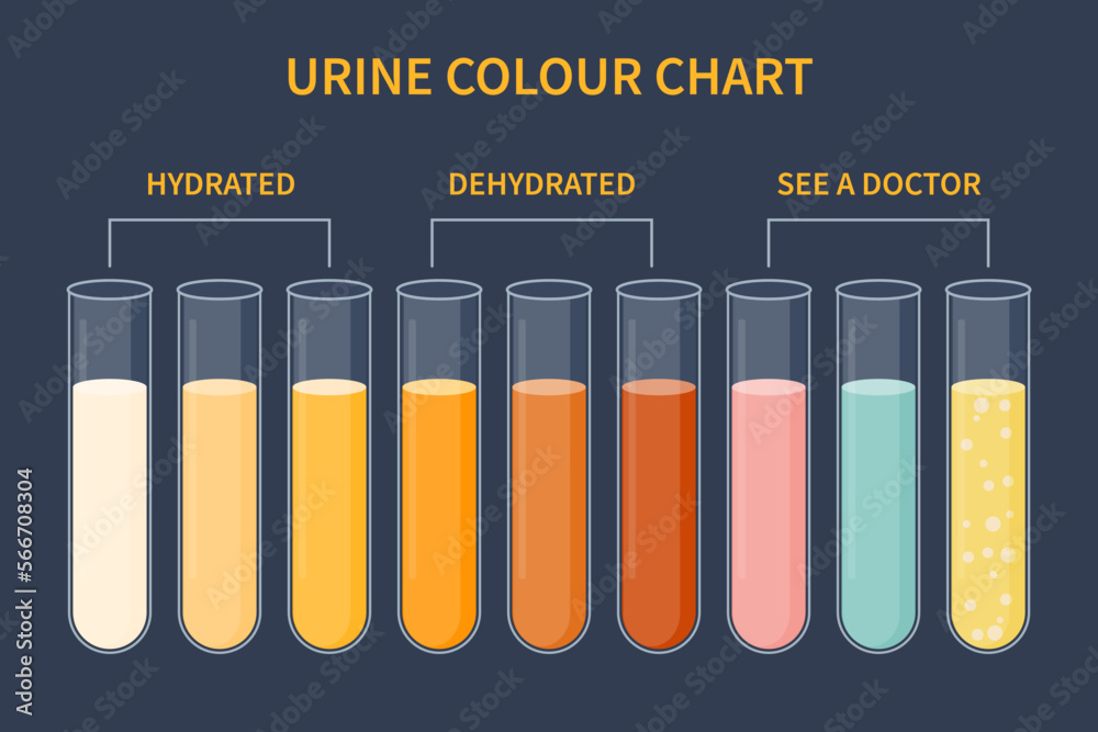 Urine colour chart. Hydration and dehydration level diagram. Medical ...