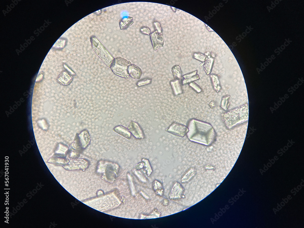 Microscopic view of struvite crystals from urinary sediment. Magnesium ...