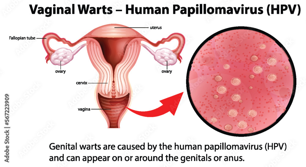 Vaginal Warts Human Papillomavirus Hpv Infographic With Explanation 3646