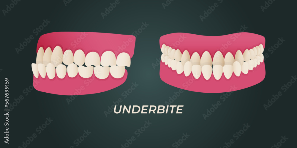 Human teeth malocclusion set with realistic images of mouth jaws with ...