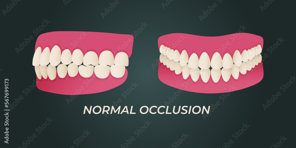 Human teeth malocclusion set with realistic images of mouth jaws with ...