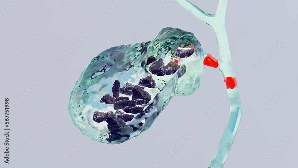 Gallstones in the gallbladderand bile duct, human silhouette and ...