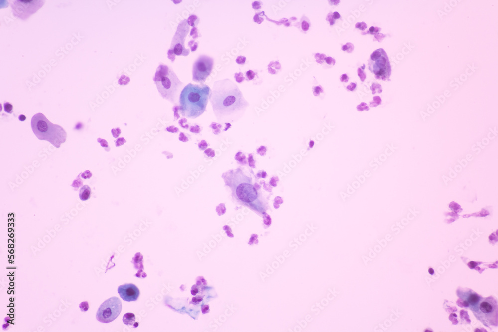 iew in microscopic of Abnormal human cervix cells.Squamous epithelium ...