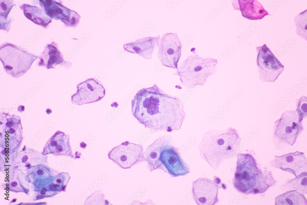 Foto de Stock Abnormal squamous epithelial cells view in microscopy.HPV ...