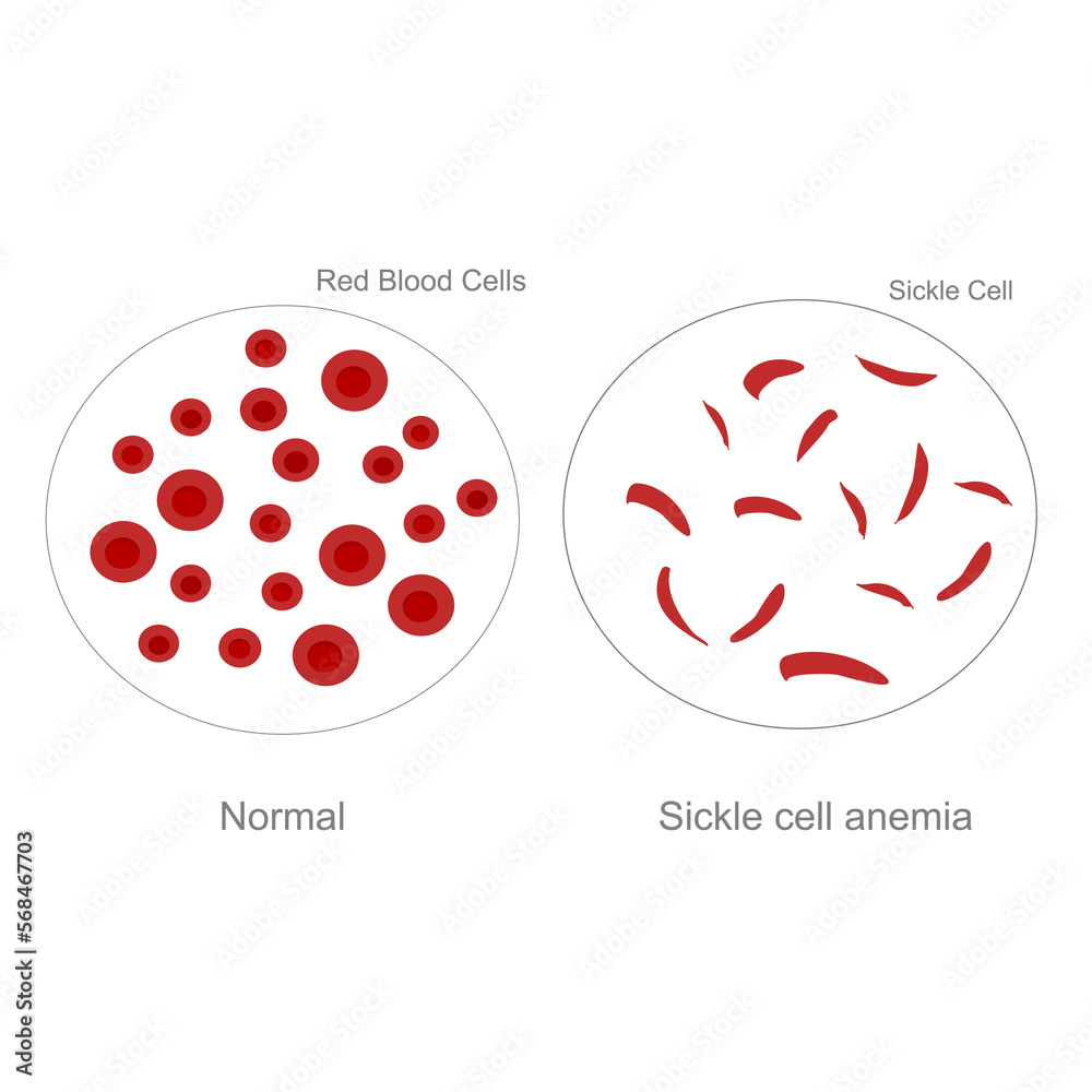 The difference morphology of Red Blood cells between Normal cells and ...
