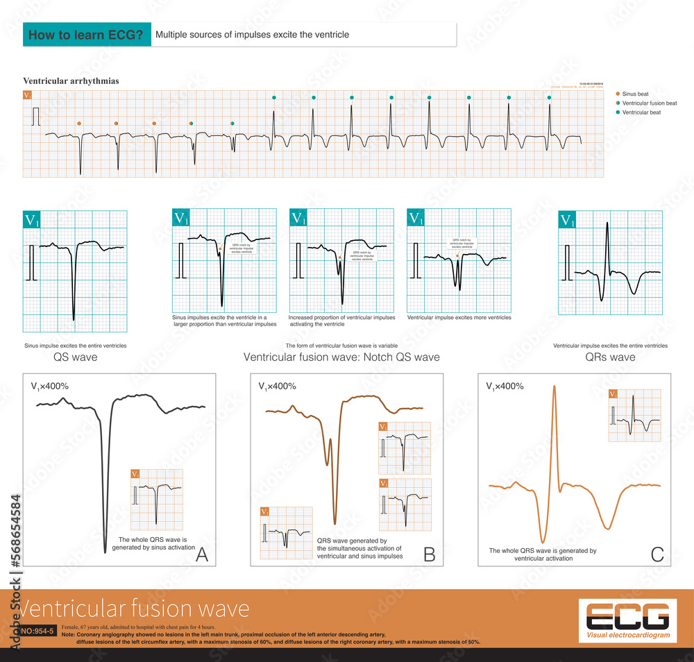 Ventricular fusion wave is a QRS wave generated by impulses from ...