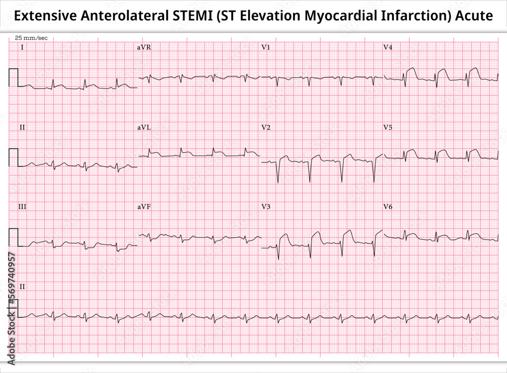 Extensive Anterolateral STEMI (ST-Elevation Myocardial Infarction) Acute - ECG Paper 12 Lead ...