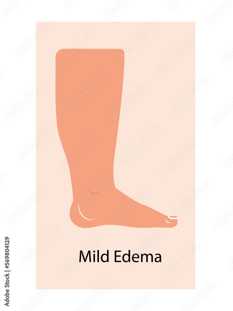 Lymphedema stages. Lymphatic system dysfunction disease. Swollen legs ...