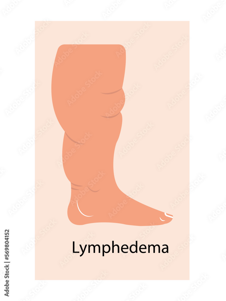 Lymphedema stages. Lymphatic system dysfunction disease. Swollen legs ...