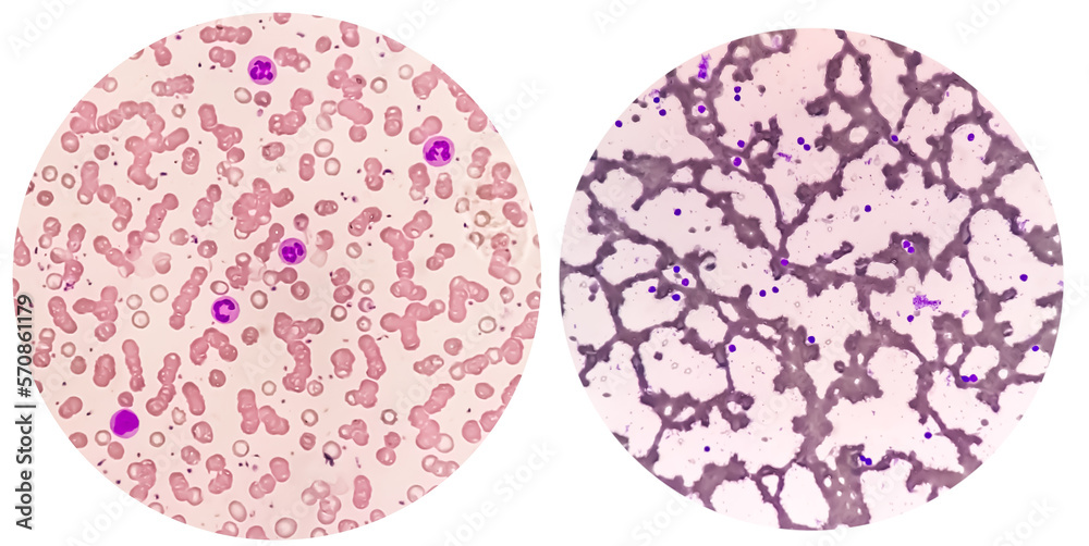 Blood Film or Peripheral blood smear: Microcytic hypochromic anemia ...