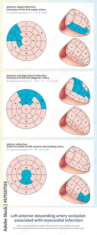 Occlusion of the left anterior descending artery in different parts ...
