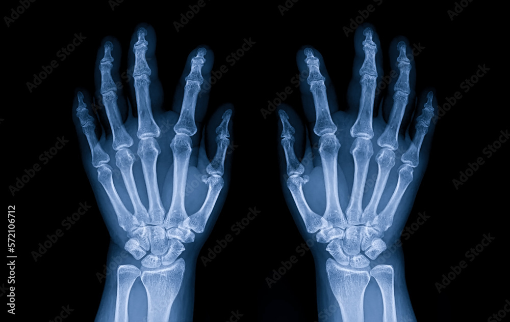 Blue tone radiograph on dark background in hospital.Doctor used xray ...