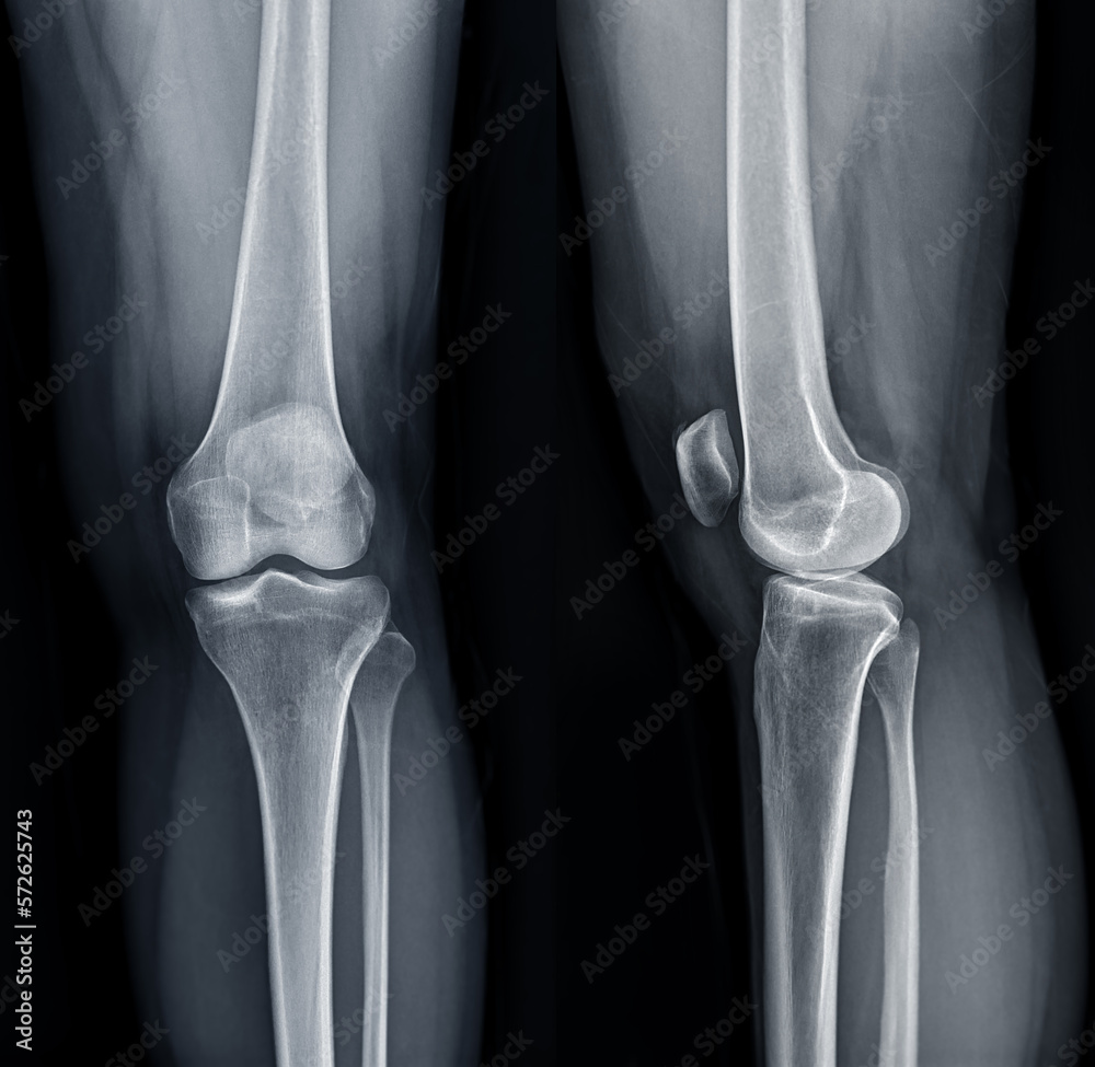 Film x-ray of Left knee joint AP and Lateral view for diagnosis knee ...