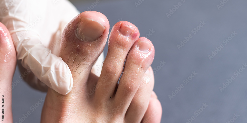 A white man holding his toes, showing what looks like a rash with red ...