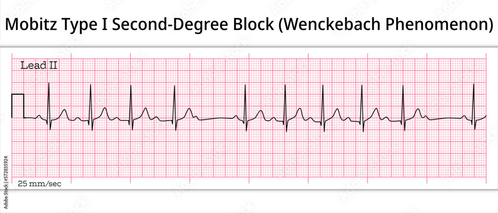 Wenckebach Phenomenon - ECG Mobitz Type 1 Second Degree Atrioventricular Block - 2nd degree AV ...
