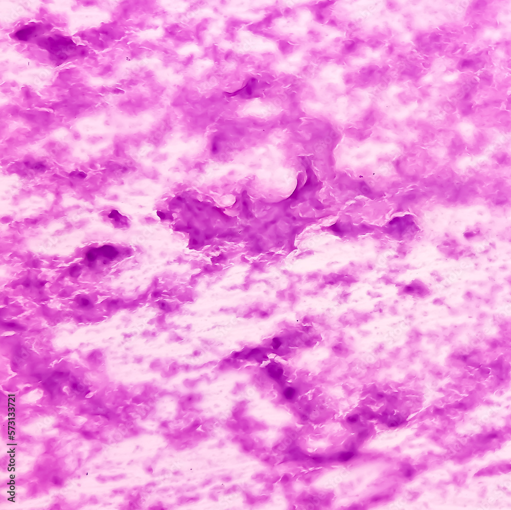 Stock-Foto „Scalp swelling cytology: Epidermal inclusion cyst. commonly ...