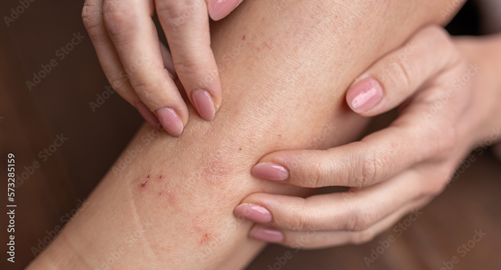 A red rash caused by allergy, inflammatory process. Eczema, atopic ...